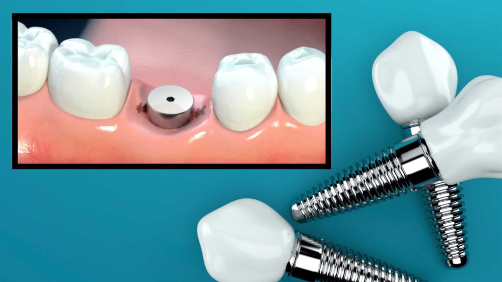 What is an Implant Healing Cap? | Cleveland Smile Center